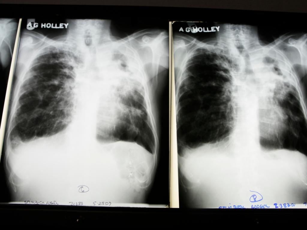 Zurich: nouvelle souche de tuberculose multirésistante identifiée - SWI ...